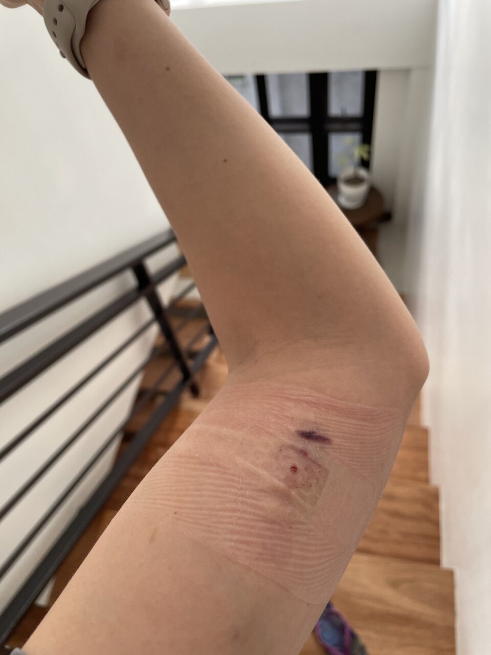 I Got a Contraceptive Implant and Here's What Happened