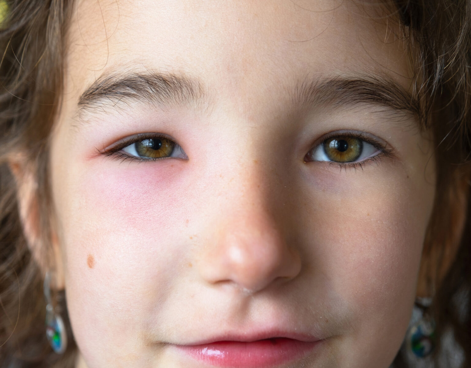 How Parents Can Treat Their Kids' Stye | Modern Parenting