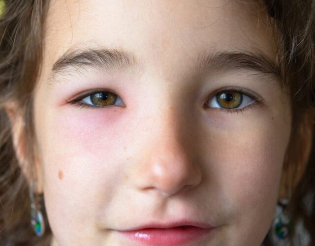 How Parents Can Treat Their Kids' Stye | Modern Parenting