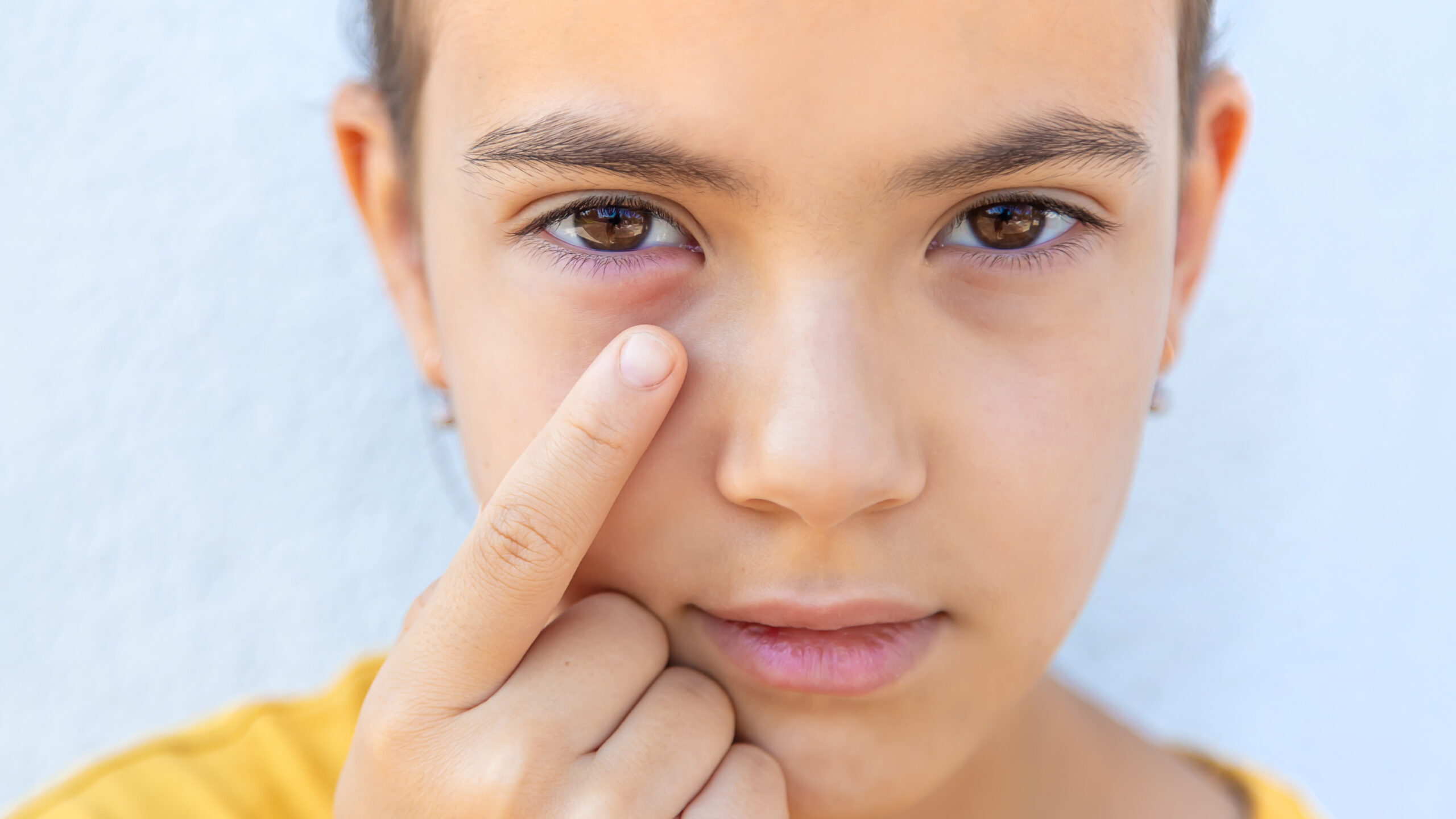 How Parents Can Treat Their Kids' Stye | Modern Parenting