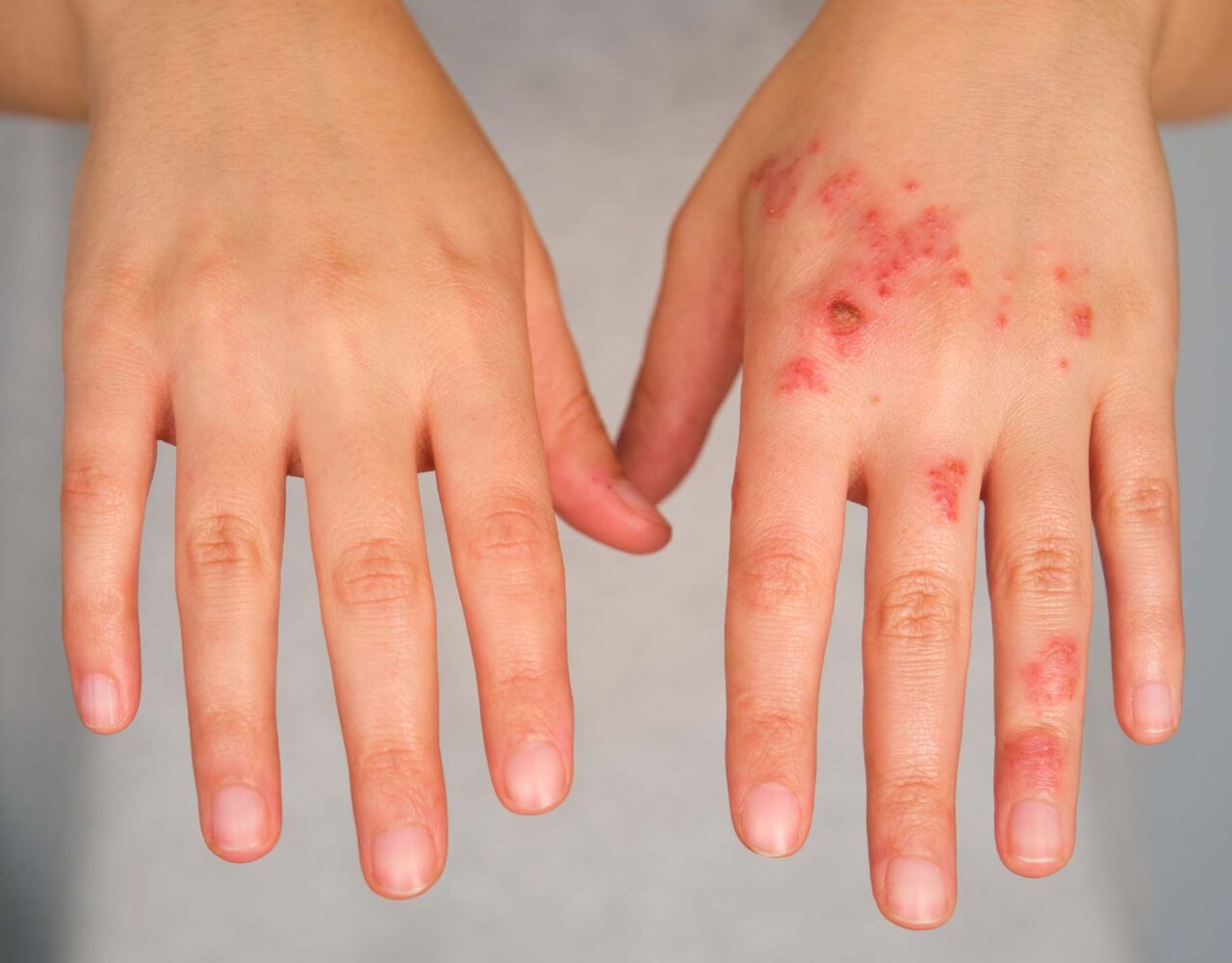 Monkeypox Outbreak: Here's What We Know So Far