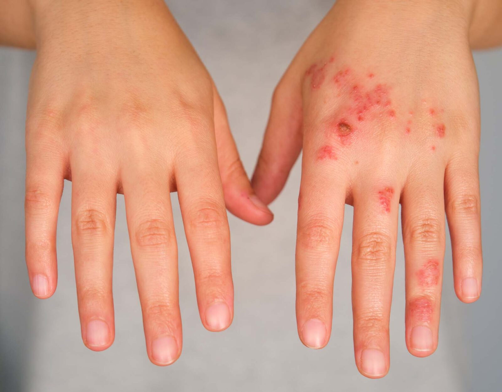 Monkeypox Outbreak: Here's What We Know So Far